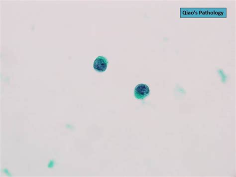 Qiaos Pathology Malignant Ascites With Metastatic Breast Cancer Cells