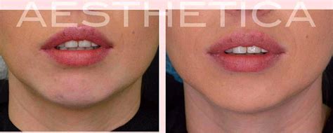 Using Botox On Chin Facial Injections Info Prices Photos Reviews Qanda