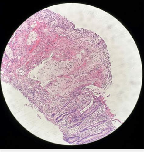 Benign Polypoid Colonic Mucosa Showing Histology Consistent With