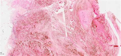 Acute Pancreatitis Gross