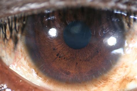 Modern And Multidimensional Iridology Iris Signs At Internal And External Of Distended Collarette