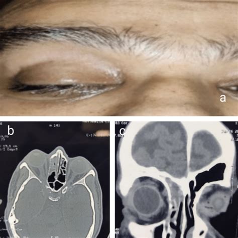 A Post Fess B C Ct Of The Patient Showed Mucosal Thickening In Right Download Scientific