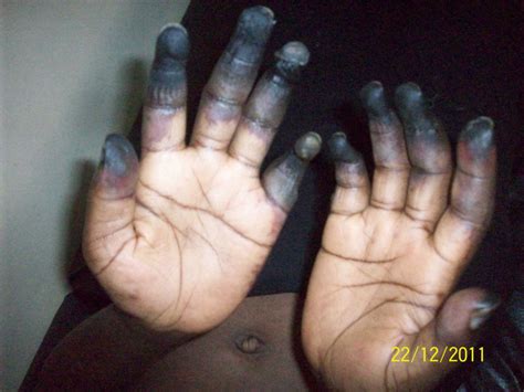 Digital Gangrene As The Initial Presentation Of Systemic Lupus