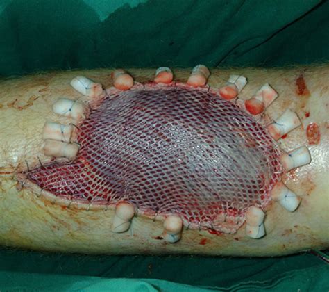 Open Tib Fib Fracture