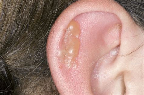 Herpes Simplex Lesion Stock Image C0017024 Science Photo Library