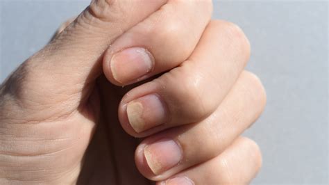 Why Are My Nails Separating Everything You Need To Know About Onychol