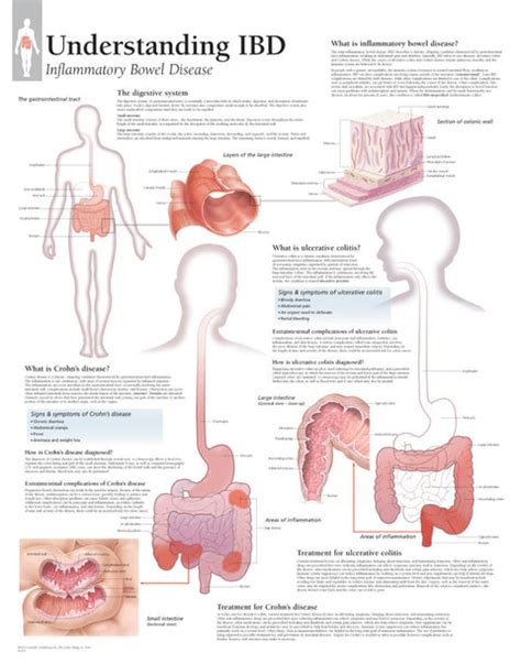 Chart Understanding Ibd