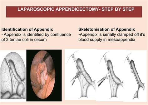 Acute Appendicitis Appendicectomy Open And Laparoscopic Pdf