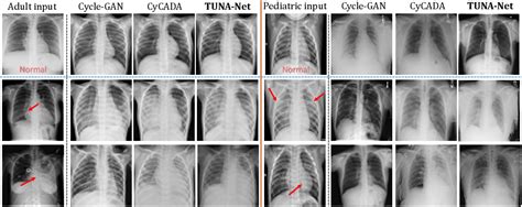tuna net task oriented unsupervised adversarial network for disease