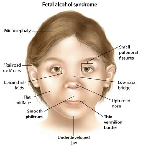 Pin On Syndrome