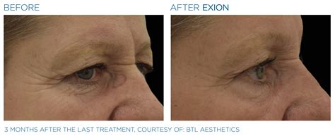 Exion® Fractional Rf Skin Treatment Toronto Vitalitymd Toronto