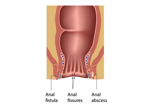 Internal Anal Fissure