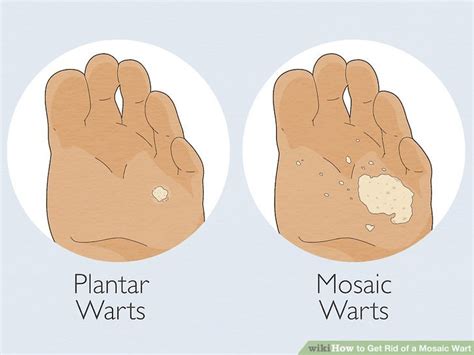 How To Get Rid Of A Mosaic Wart With Pictures Wikihow