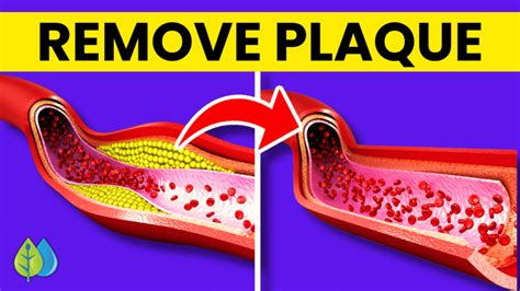 How To Cleanse Your Arteries With Only 3 Ingredients