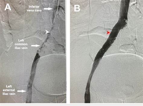 Venogram Performed The Next Day Of Presentation After Catheter Directed