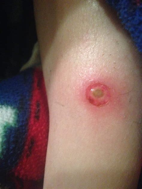 Brown Recluse Spider Bite Ridge Haven Homestead