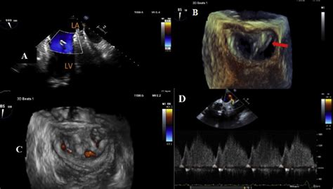 Transesophageal Echocardiogram A Two Chamber View Showing Mv Inflow