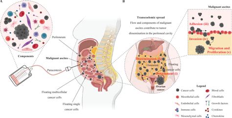 Figure 1 The Accumulation Of Malignant Ascites Ovarian Cancer