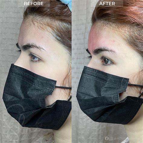 💕🎀 Barbie Forehead 🎀💕 One Of Skin 360 Aesthetics Center