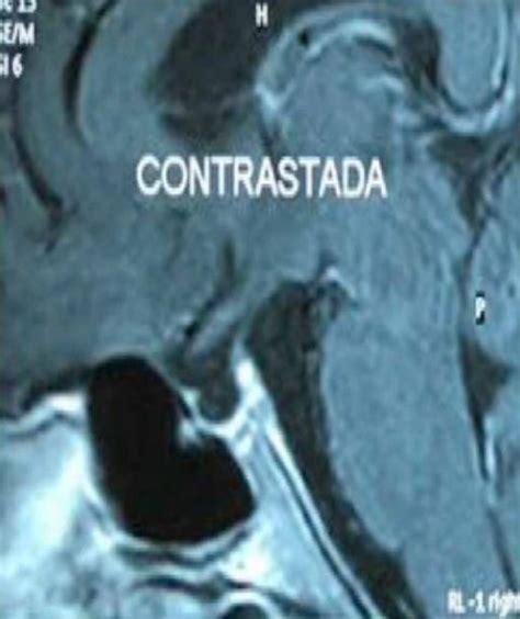Aracnoidocele Selar Como Causa De Hiponatremia Severa Revista Indexia