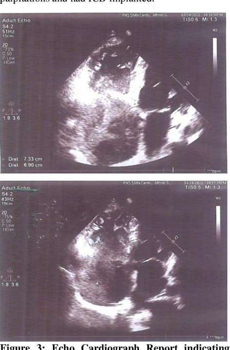 Figure 3 From A Case Report Of Arrythmogenic Right Ventricular