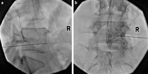 Hypogastric Nerve Block