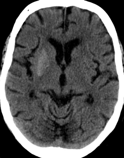 Non Contrast Axial Ct Image Showing Mild Diffuse Hyperdensity Of The Download Scientific