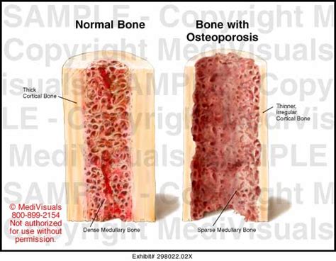 Normal Bone Vs Osteoporosis Medical Illustration