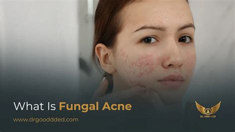 What Is Fungal Acne Causes Symptoms And Treatment