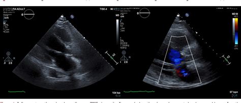 Figure 4 From Aerococcus Urinae Aortic Valve Endocarditis With Kissing Aortic Wall Ulcer A Case