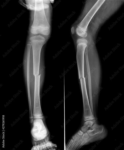 Radiography Of Tibial Fracture At Mid Shaft Of The Bone In Babe Babe Patient Stock Photo