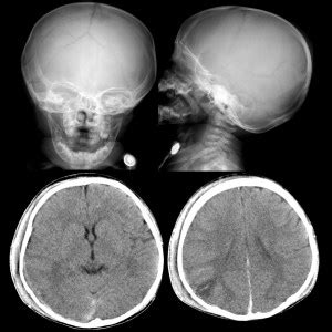 Pediatric Subdural Hematoma Pediatric Radiology Reference Article