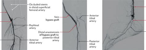 Bypass Grafting To Infrainguinal Targets In Pad Completion