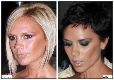 Plastic Surgery Before And After Victoria Beckham Plastic Surgery