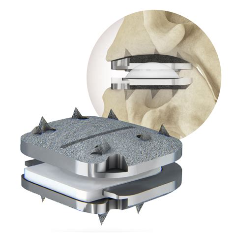 Cervical Disc Replacement Aoa Orthopedic Specialists