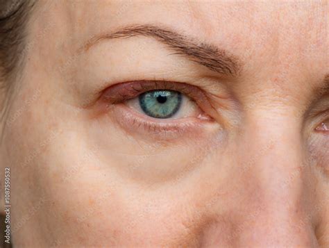 Inflammatory Process On The Upper Eyelid Barley Chalazion Swelling And Redness On The Upper