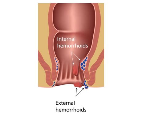 Rectal Internal Hemorrhoids