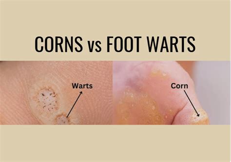 Corns Vs Foot Warts Talaria Podiatrist