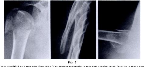 Figure 1 From The Neer Classification System For Proximal Humeral Fractures Semantic Scholar