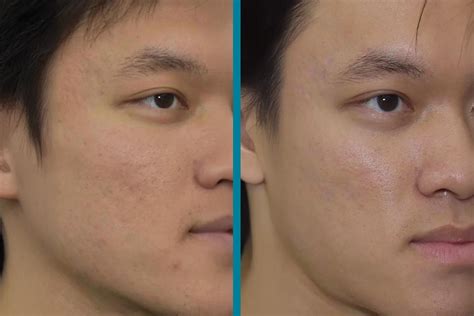 Acne Scars Before And After