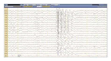 An Interictal Eeg Sample Showed 3 Hz Generalized Spike And Wave Download Scientific Diagram
