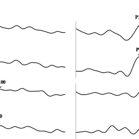 pattern visual evoked potential pvep test of both eyes of a