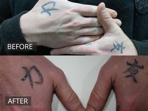 Skin Graft Tattoo Removal