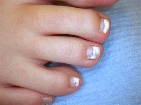 What Are The 4 Different Types Of Toenail Fungus