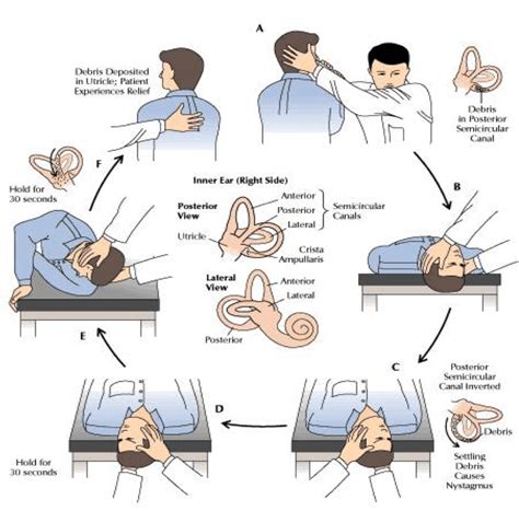 Horizontal Canal Repositioning Maneuver