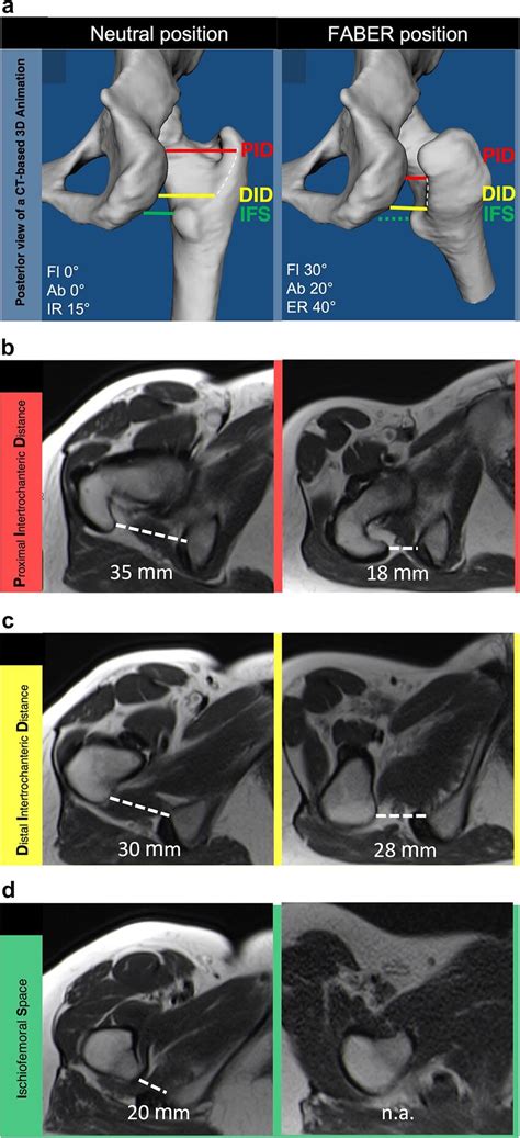 A Posterior View Of A Ct Based 3d Animation Of A Right Hip Joint In Download Scientific Diagram