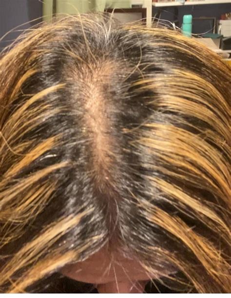 Hair Loss With Bupropion Rwellbutrinbupropion