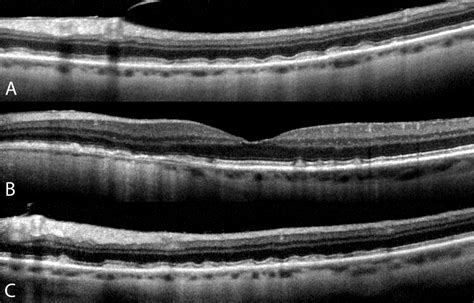 Prevalence And Significance Of Subretinal Drusenoid Deposits Reticular