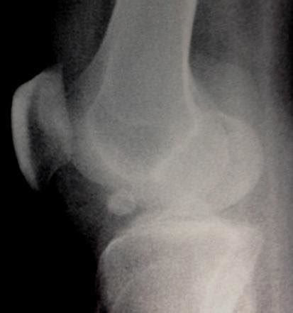 Anterio Posterior And Lateral View Of Knee Joint Showing Multiple Loose