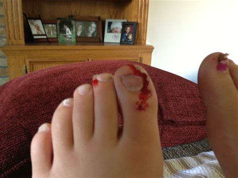 Some Sore Toes After Accident On The New Bike Sore Toe Soreness